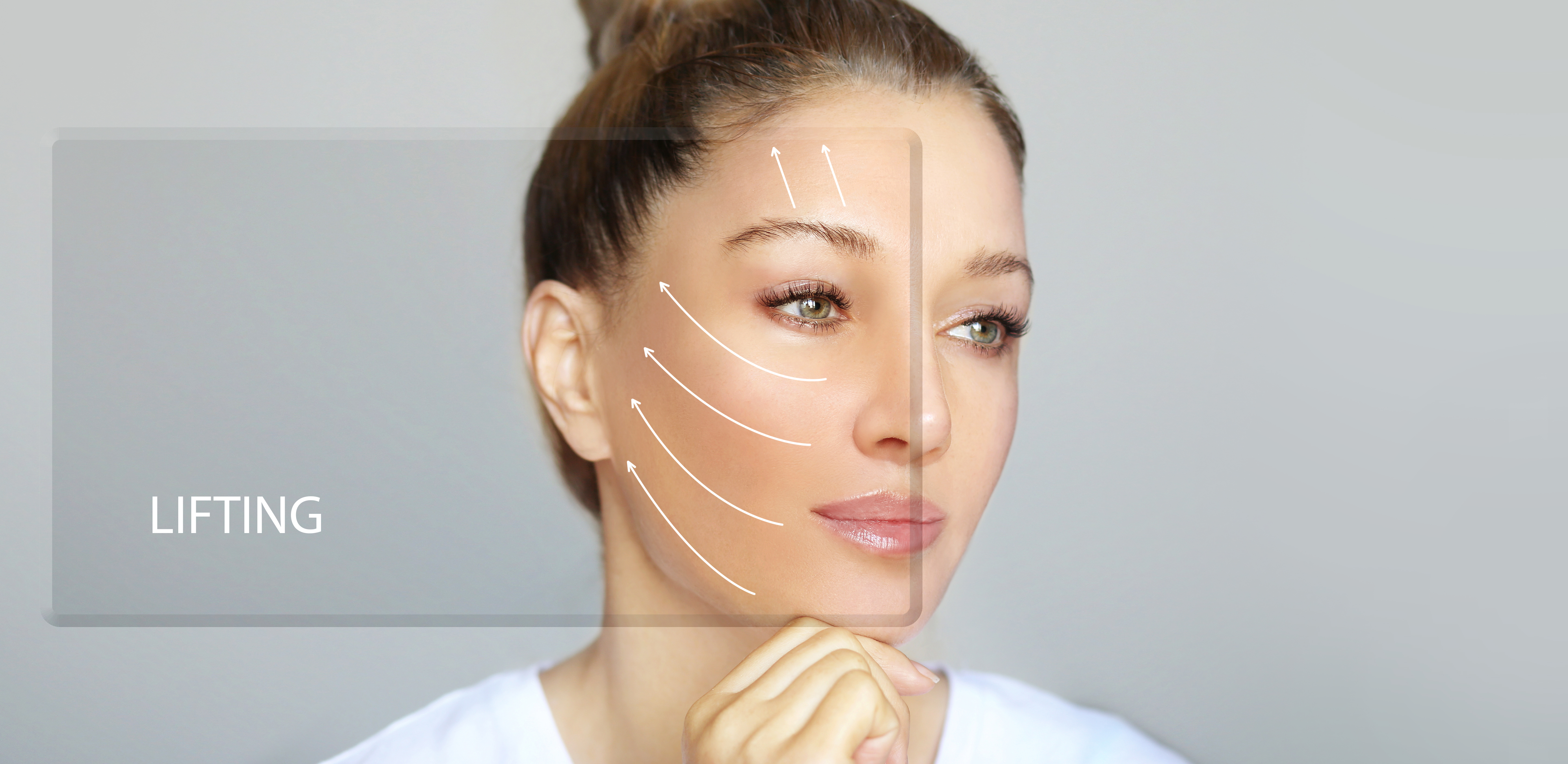 Non-Pull Thread Lifts with PLLA/PLGA Threads: The Future of Facial ...