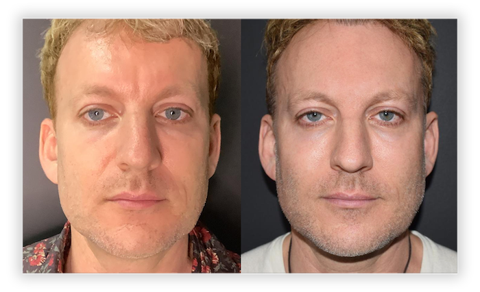 Before & After Thread Lift Procedures | Thread Lift Doctor