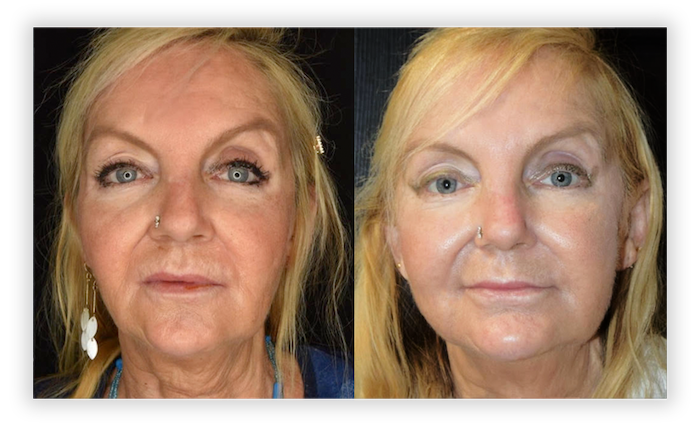 Before & After Thread Lift Procedures | Thread Lift Doctor