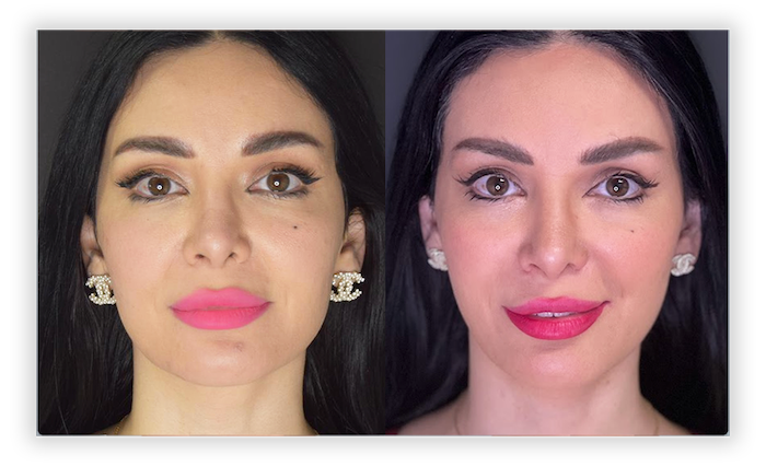 Before & After Thread Lift Procedures | Thread Lift Doctor