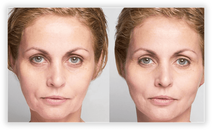 Before & After Thread Lift Procedures | Thread Lift Doctor