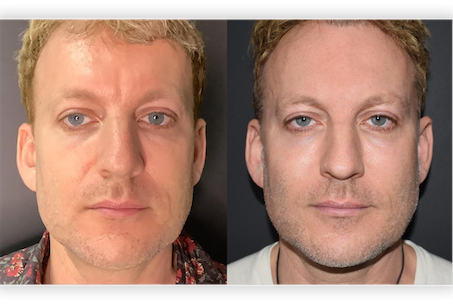 Before & After Thread Lift Procedures | Thread Lift Doctor