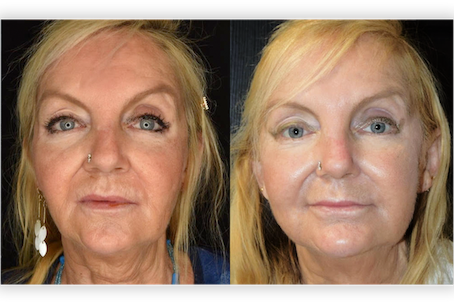 Before & After Thread Lift Procedures | Thread Lift Doctor