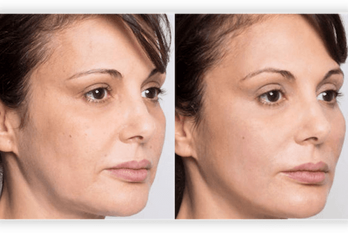 Before & After Thread Lift Procedures | Thread Lift Doctor