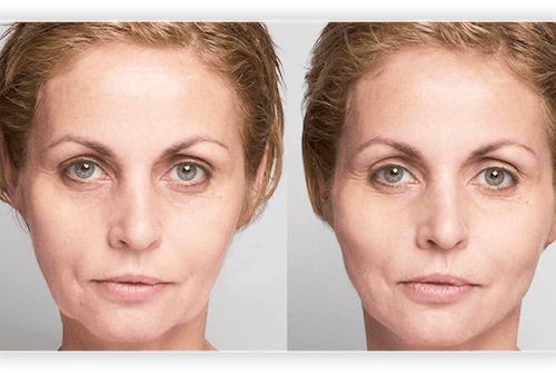 Before & After Thread Lift Procedures | Thread Lift Doctor