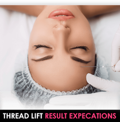 Thread Lift Procedures in Toronto & Mississauga | Thread Lift Doctor