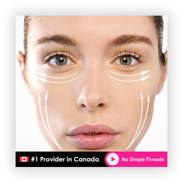 Top Thread Lift & Bellafill® Provider – Mississauga, Oakville, Toronto